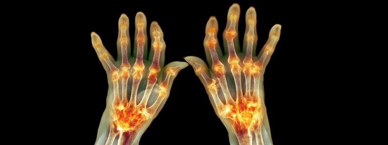 Autoimmune Arthritis Treatment - Lomibao Rheumatology Dallas